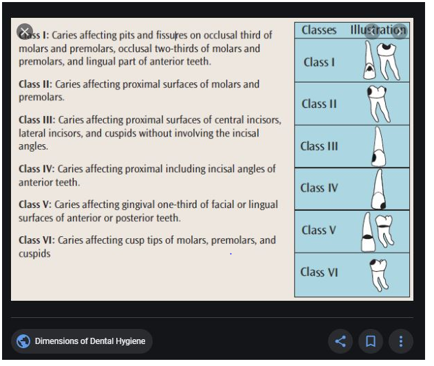 The Rules of Cavity Preparation and Fillings, and How We Chart in a ...
